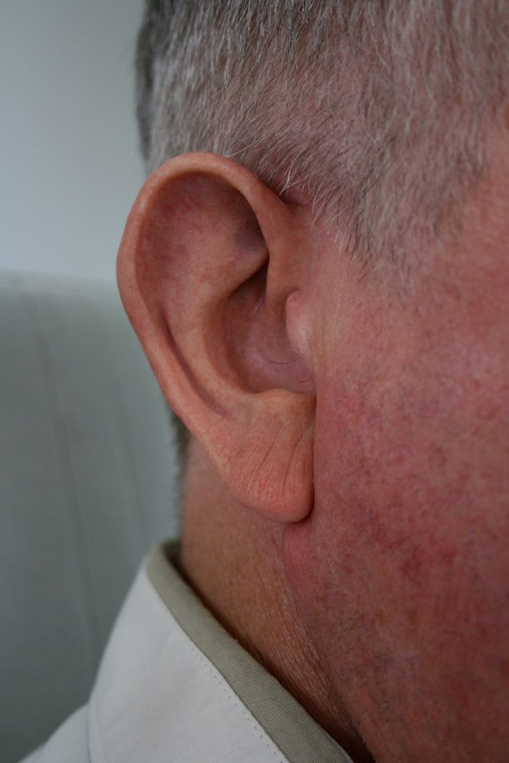 Ohrepithese - Institut für Anaplastologie