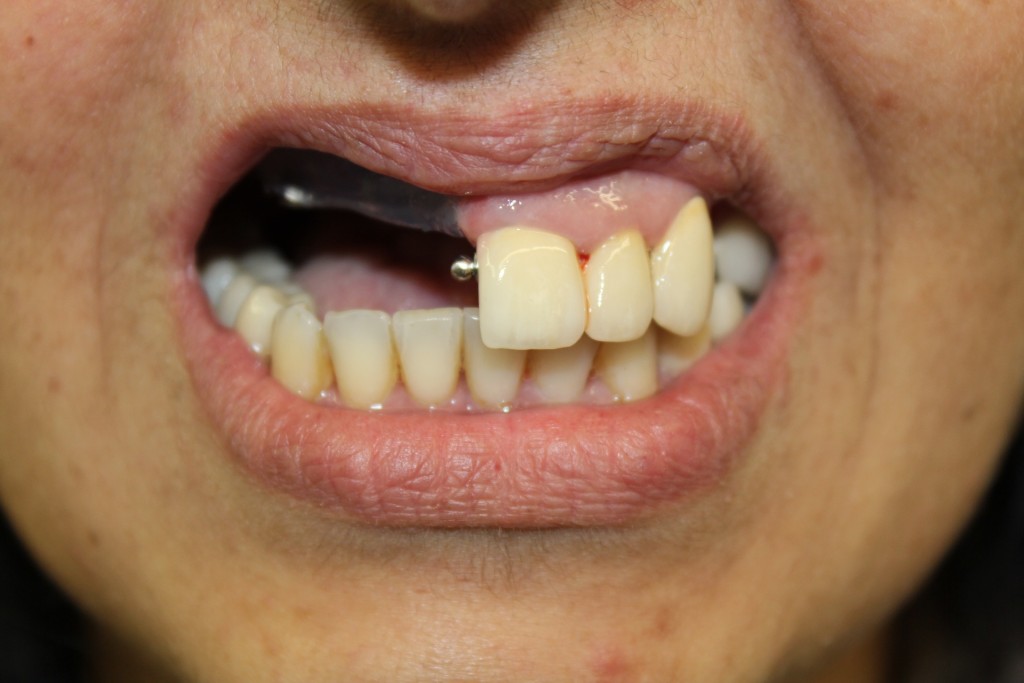 Zahntechnik — Prothetik - Institut für Anaplastologie