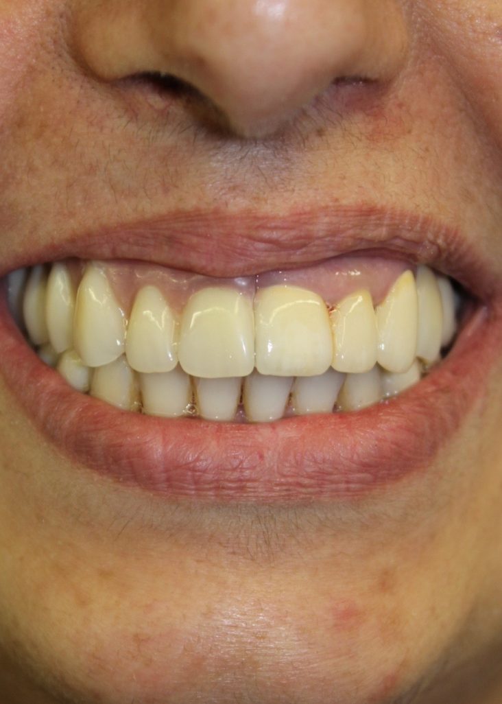 Zahntechnik — Prothetik - Institut für Anaplastologie